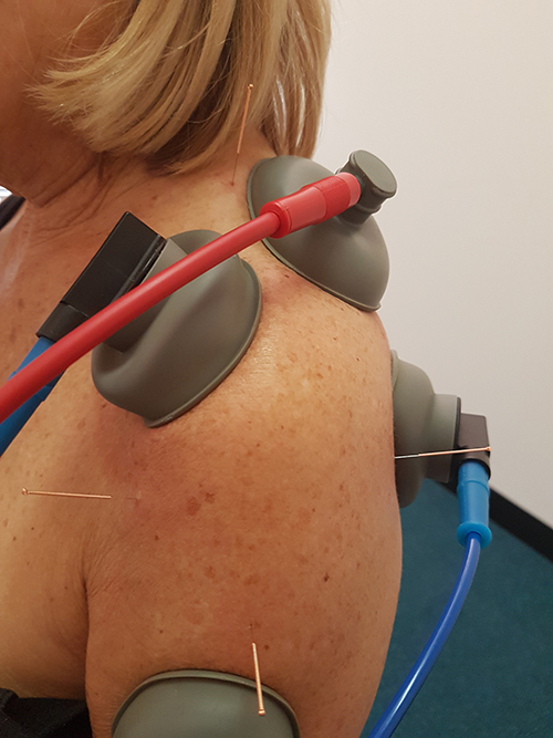Acromioclavicular Joint Sprain Shoulder Sprain Chiropractic Solutions